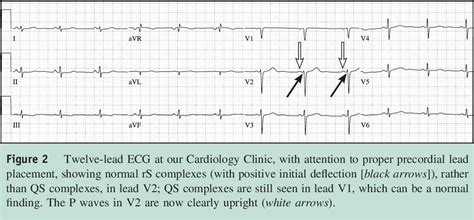 What Is Septal Infarct