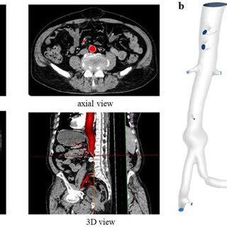 Reconstruction Of The Three Dimensional Model Using Ct Scan Dicom Image