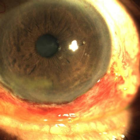 First Post Operative Day Showing Small Corneal Epithelial Defect And