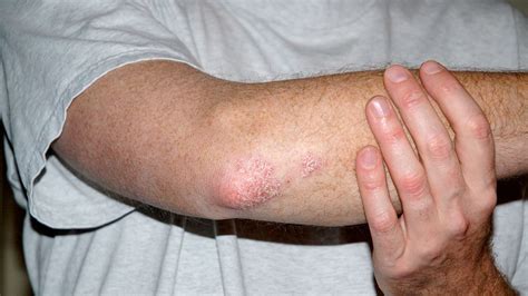 Psoriasis Elbow