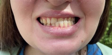Patient With Dislocated Jaw And Malocclusion Temporomandibular Joint