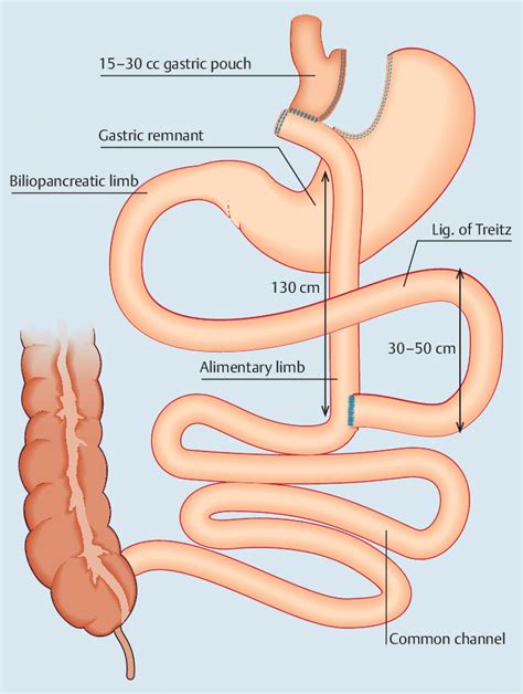 Roux En Y Gastric Bypass Configuration The Proximal Jejunum Is Divided