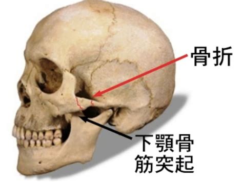頬骨骨折の症状治療後遺症 骨筋肉関節の病気 All About