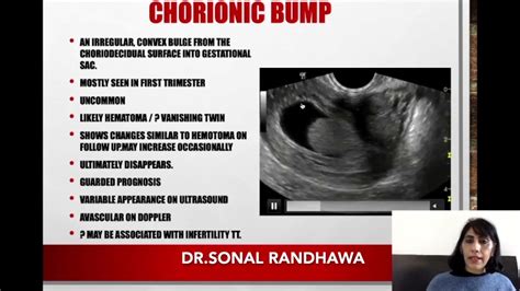 Chorionic Bump Youtube