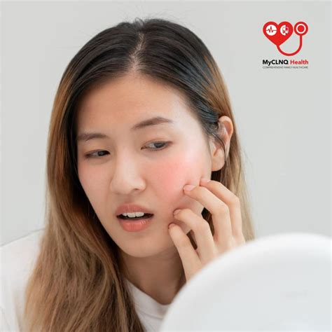Rosacea Signs Symptoms Healthylifestyle Digitalhealthcare