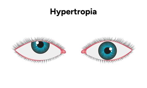 Premium Vector Eye Problem Disease Strabismus Hypertropia