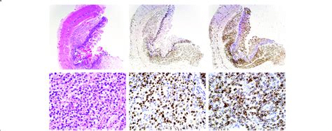 Submucosal Infiltrate Of Polymorphic Atypical Cells In The Terminal Download Scientific
