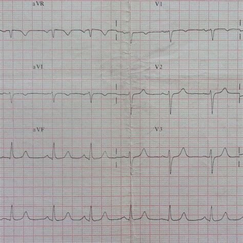 Polymorphic Ventricular Tachycardia Pvt Triggered By Ventricular Download Scientific Diagram