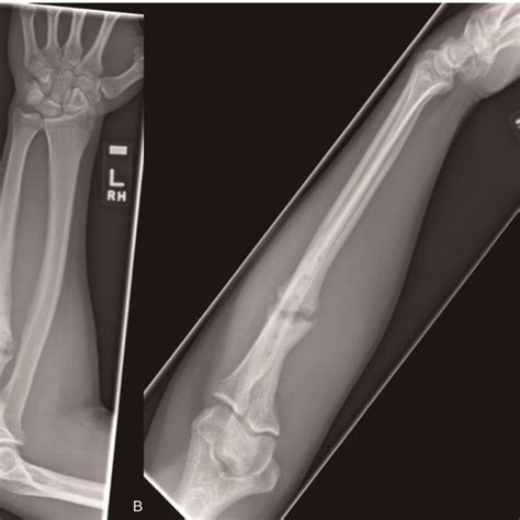 A Ap And B Lateral Radiographs At 6 Month Follow Up When The