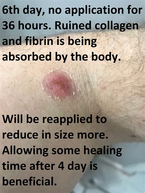 Keloid Hypertrophic Scar Dissolve Gel Madecassoside Etsy