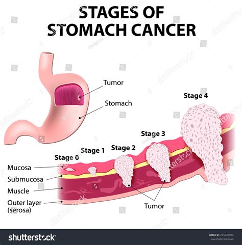 The Clinical Stages Of Stomach Cancer Classification Of Malignant