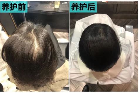 头顶稀疏怎么办，三招让头发恢复 哔哩哔哩