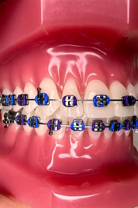 Black Braces Bands Artofit