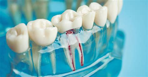 Why Not Extract A Tooth Root Canal Is The Better Fix