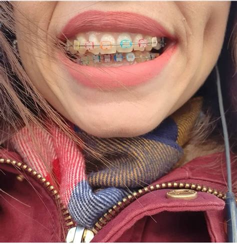 Braces Colors For Brunette At Roger Monday Blog