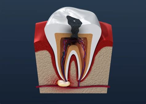 What Causes A Root Canal Infection And How To Treat It
