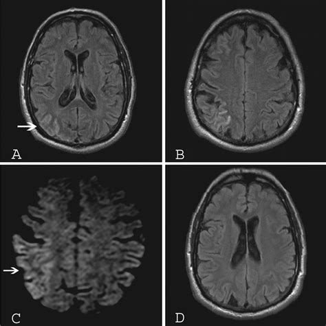 Migraine And Mri Abnormalities