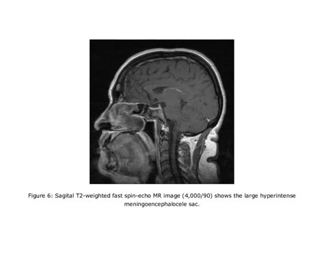 Sagital T1 Weighted Mr Image 9010 Shows Downward A Large