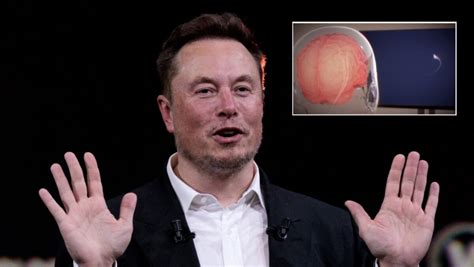 ¿cómo Funciona El Chip Telepathy De Neuralink En El Cerebro Grupo Milenio