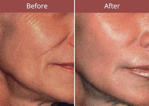 Does Glycolic Acid Burn Skin At Clarence Swingle Blog