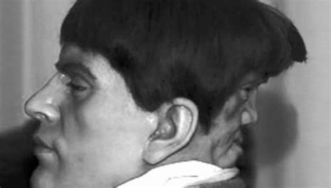 Η απίστευτη ιστορία του Edward Mordake του ανθρώπου με τα δύο πρόσωπα
