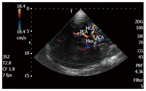 Frontiers Transcranial Doppler Ultrasonography As A 43 OFF