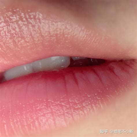 我嘴唇干裂脱皮大半年了，一直反复复发，我该怎么办啊？ 知乎