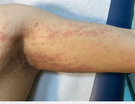 Unilateral Erythematous Edematous Papules Plaques And Papulo Vesicles