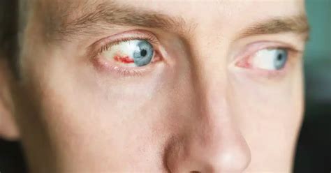 Uveitis Symptoms Understanding The Condition