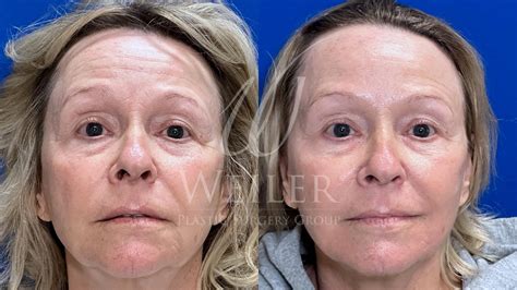 Midface Before And After Pictures Case 1457 Baton Rouge New Orleans