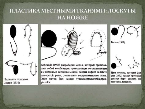 Пластика местными тканями - презентация онлайн
