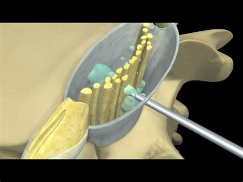 Diferencia entre la anestesia espinal y epidural Wiki Ùtil Compare la diferencia entre términos