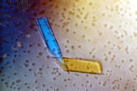 Proteína Bence Jones Actitud Saludable
