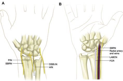 Wrist Denervation Orthopedic Clinics