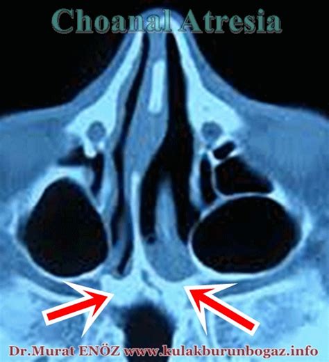 Choanal Atresia Definition Causes Symptoms And Treatment