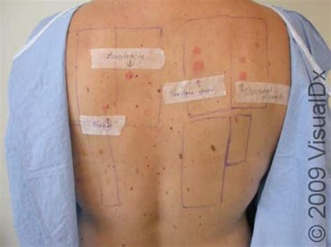 Patch Testing For Skin Contact Allergy Condition Treatments And Pictures For Skinsight