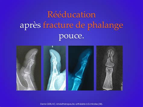 Rééducation Après Fracture De Phalange Du Pouce Denis Gerlac
