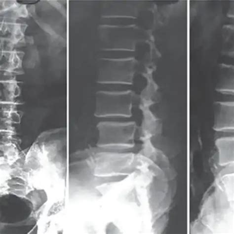 X Ray Lumbar Spine Aplateraloblique Test Price In Delhi Ganesh