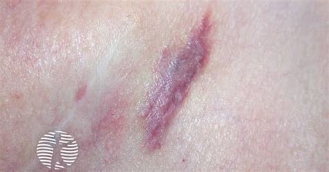 Cutaneous Metastasis Image