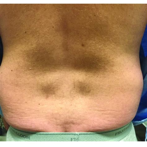 Paraspinal Muscle Atrophy In Proband 2 Image Of Proband 2s Back