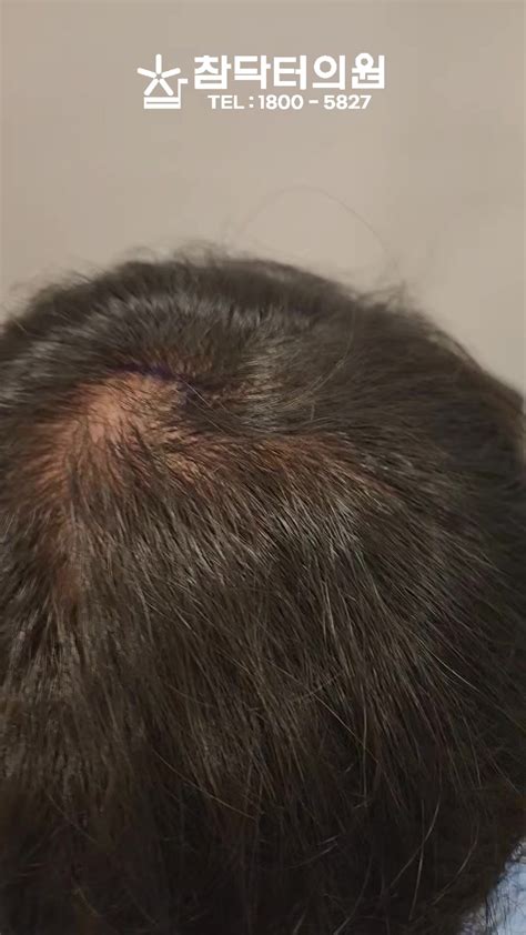 정수리탈모엔 머리카락 굵어지는 방법은 없으니 모발이식이 정답입니다 참닥터 모발이식 밀도보강 탈모약 정수리탈모 탈모
