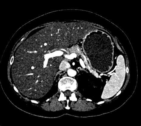Fatty Infiltration Of The Liver Liver Case Studies Ctisus Ct Scanning