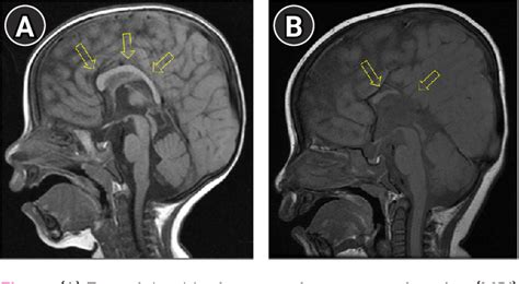 [pdf] A Missense Variation In The Kdm5c Gene Associated With X Linked Intellectual Disability