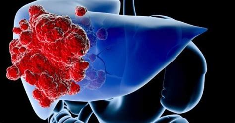Câncer De Fígado Causas Sintomas E Tratamentos Biosom