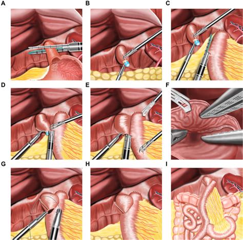 Comparison Of Outcomes Of Totally Laparoscopic Total Gastrectomy