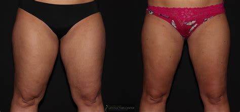 Thighs Archives St Louis Laser Liposuction Center