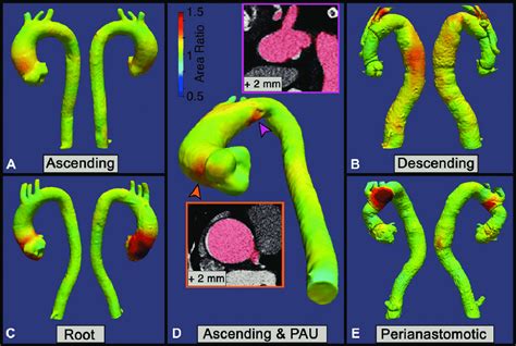 Representative Examples Of Thoracic Aortic Aneurysm Growth Patterns