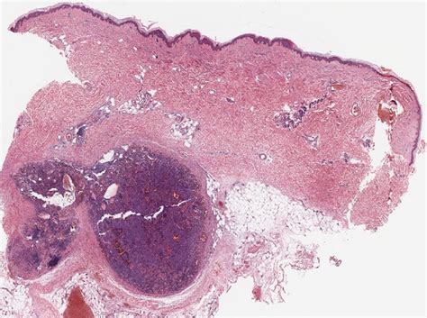 Primary Kaposi Sarcoma Of The Subcutaneous Tissue A Rare Clinical