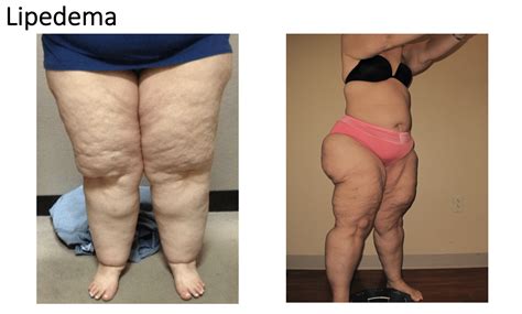 Lymphedema Vs Lipedema Lipedema Medical Solutions