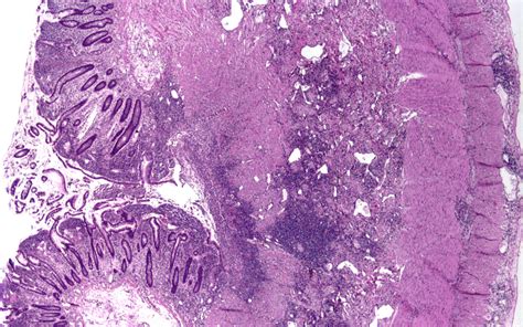 Crohns Disease Patient Resource Ascp Patient Champions